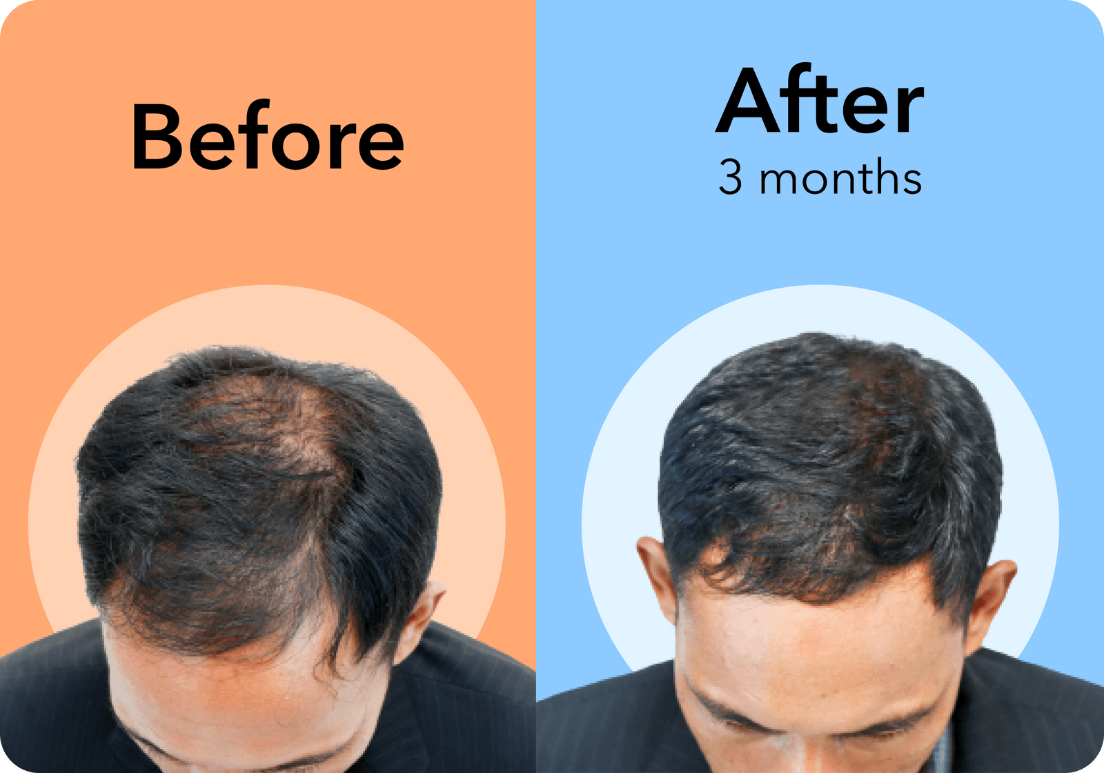 Hair Loss Prevention And Treatment